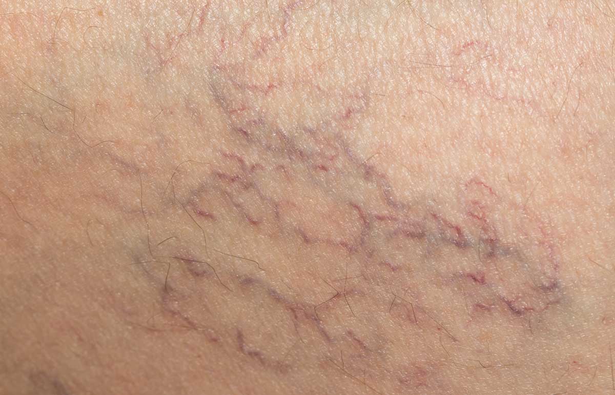 Spider Veins Treatment - Fantazia | Aesthetics | Botox | Dermal Filler ...